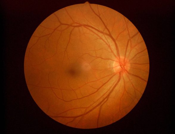 Retinal vein occlusion – Southside Eye Centre